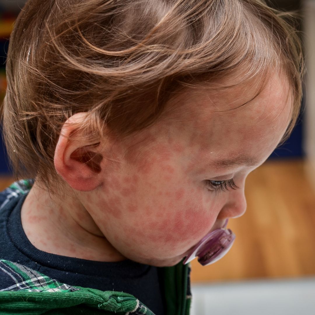 What Parents Need to Know About Measles in Texas - DFW Family Directory